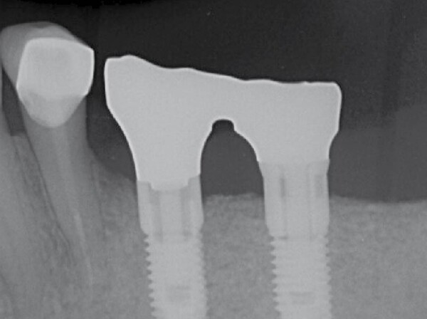 Geistlich Fibro-Gide® - Alternative Soft Tissue | Made of Collagen