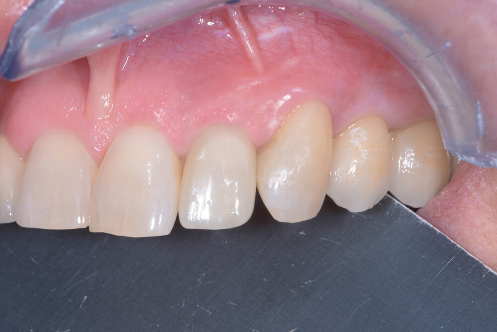 Ridge Augmentation and Delayed Implant Placement on an Upper Lateral ...