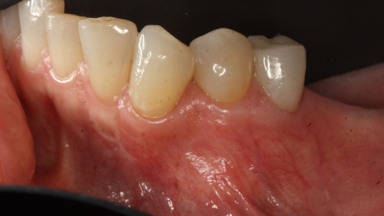 Geistlich BioBrief: Odontogenic Keratocyst Management - Geistlich