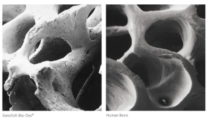 Geistlich Bio-Oss® - The Original Xenograft Bone Substitute