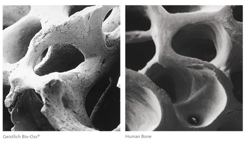 Geistlich Bio-Oss® - The Original Xenograft Bone Substitute