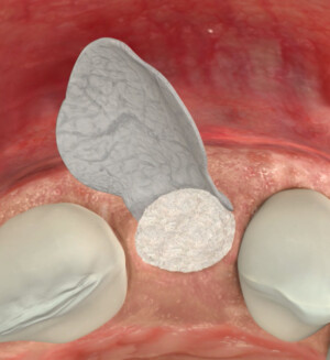 Ridge Preservation - Geistlich