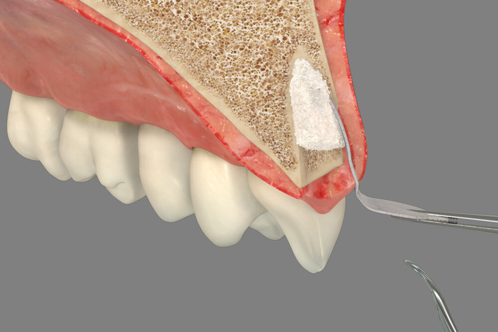 Ridge Preservation - Geistlich