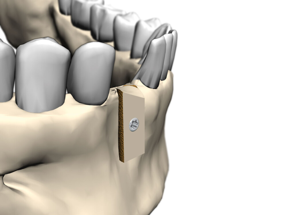 Meisinger® Screws and Screw Fixation System TX – Now Available from ...