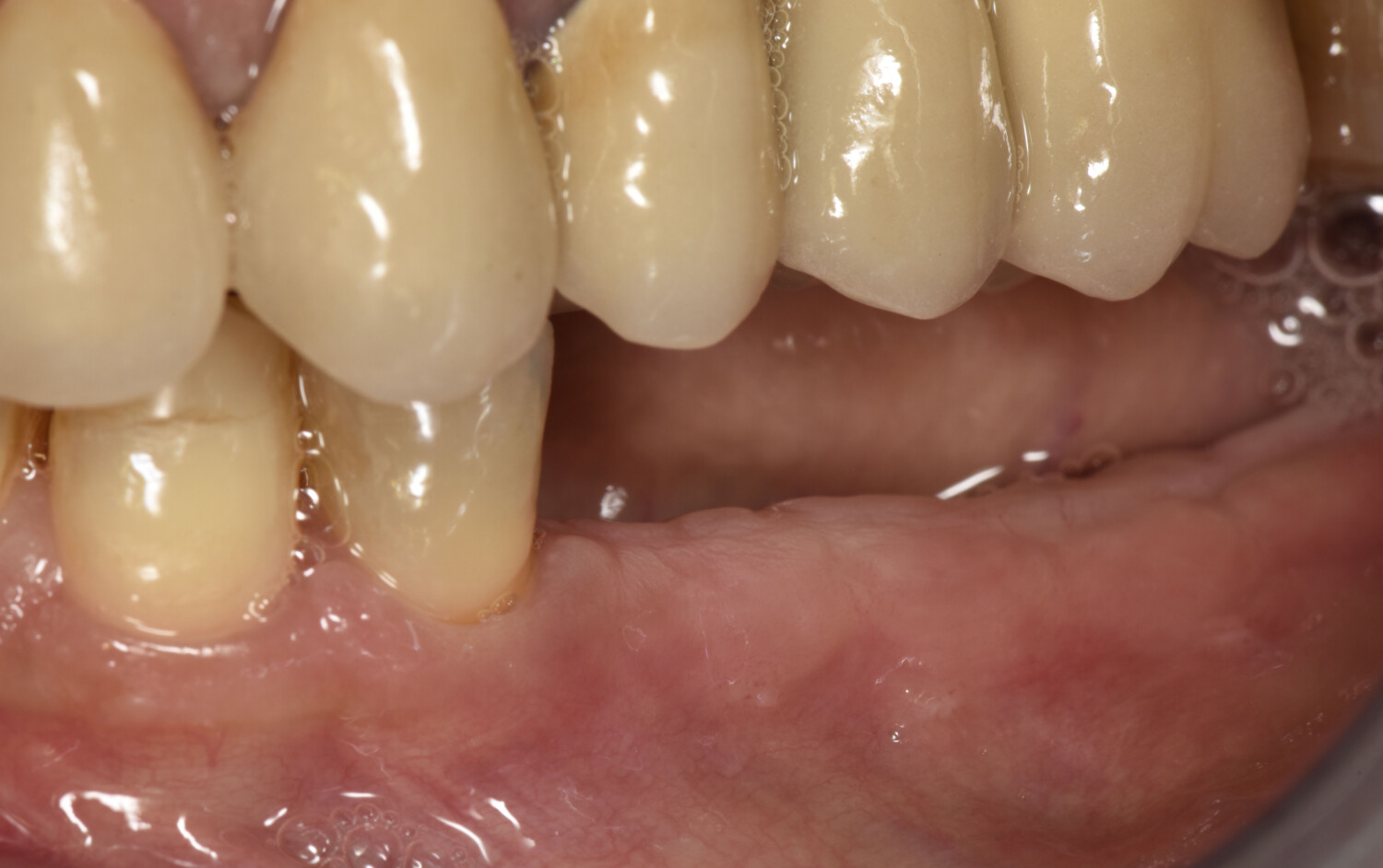 3D Bone Augmentation Using Customized Titanium Mesh in Conjunction with ...