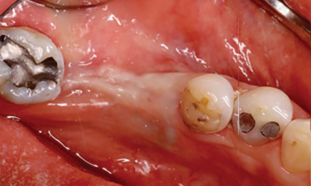 Yxoss CBR®- Customized Bone Regeneration | Titanium Mesh