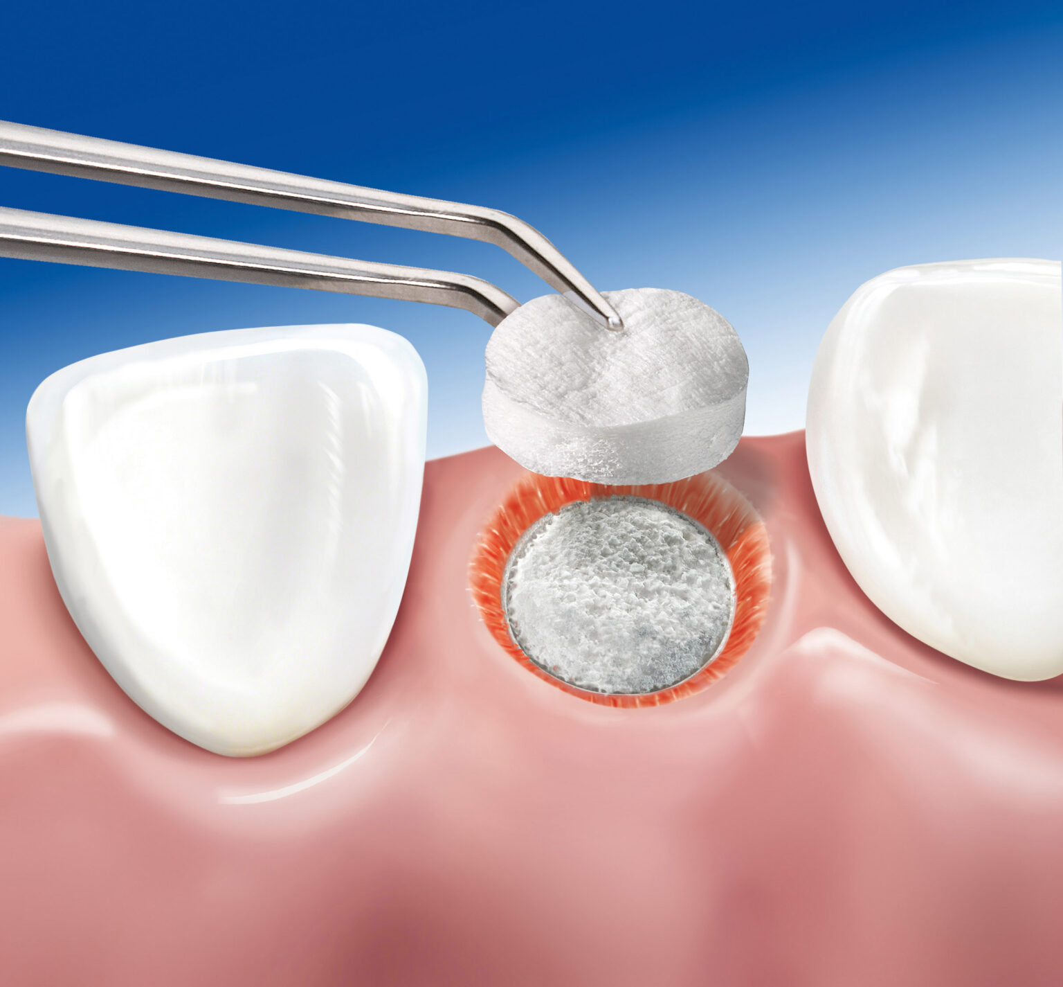 Geistlich Mucograft®- Redefining the Soft Tissue Matrix - Geistlich