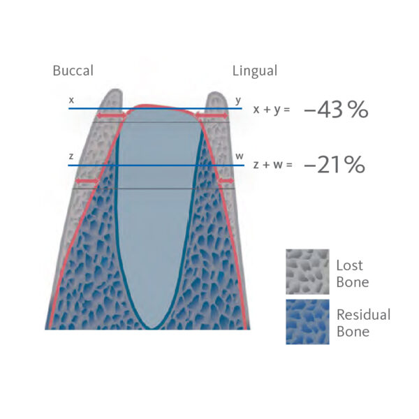Ridge Preservation - Geistlich