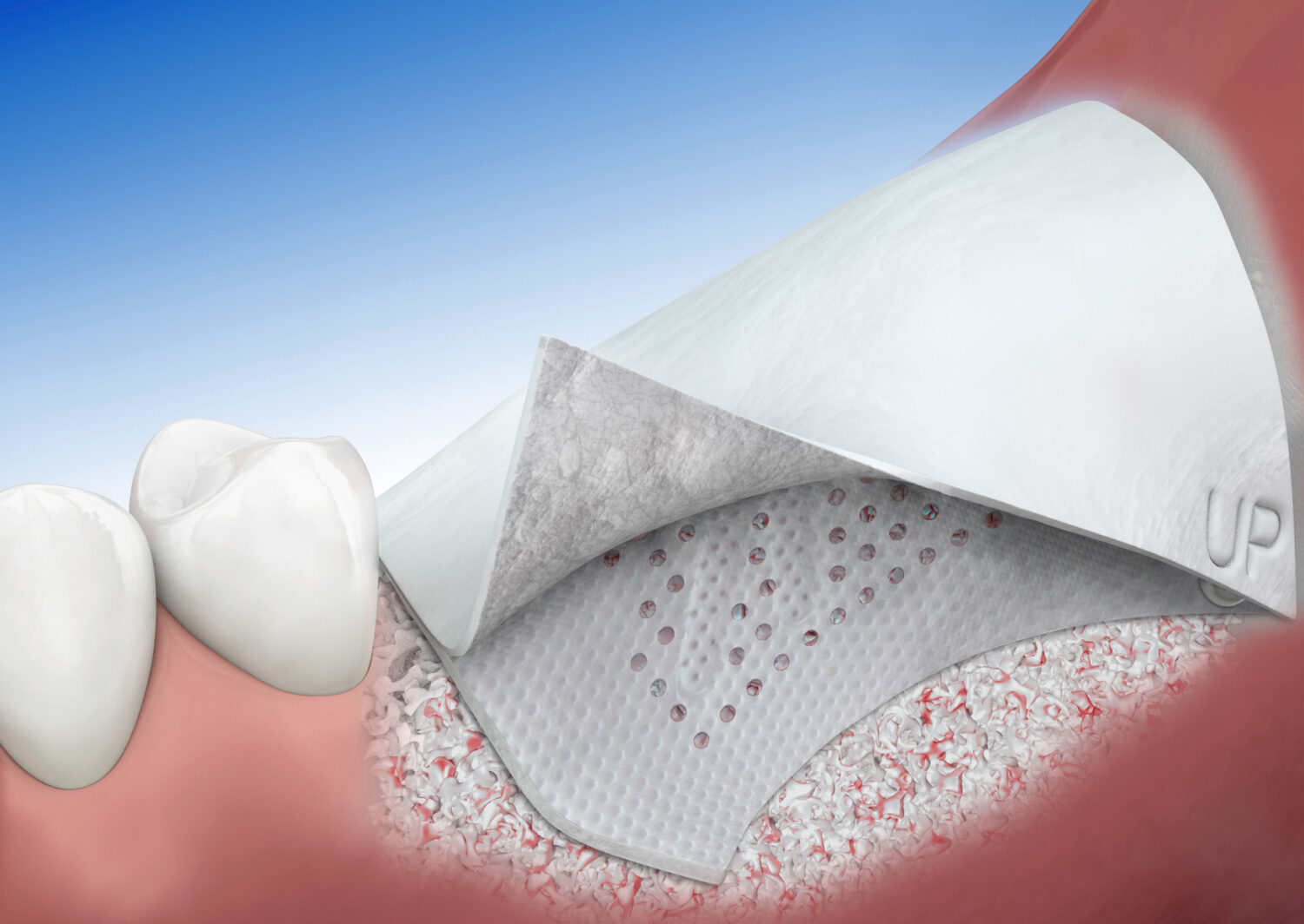 RPM™ Reinforced PTFE Mesh - Geistlich